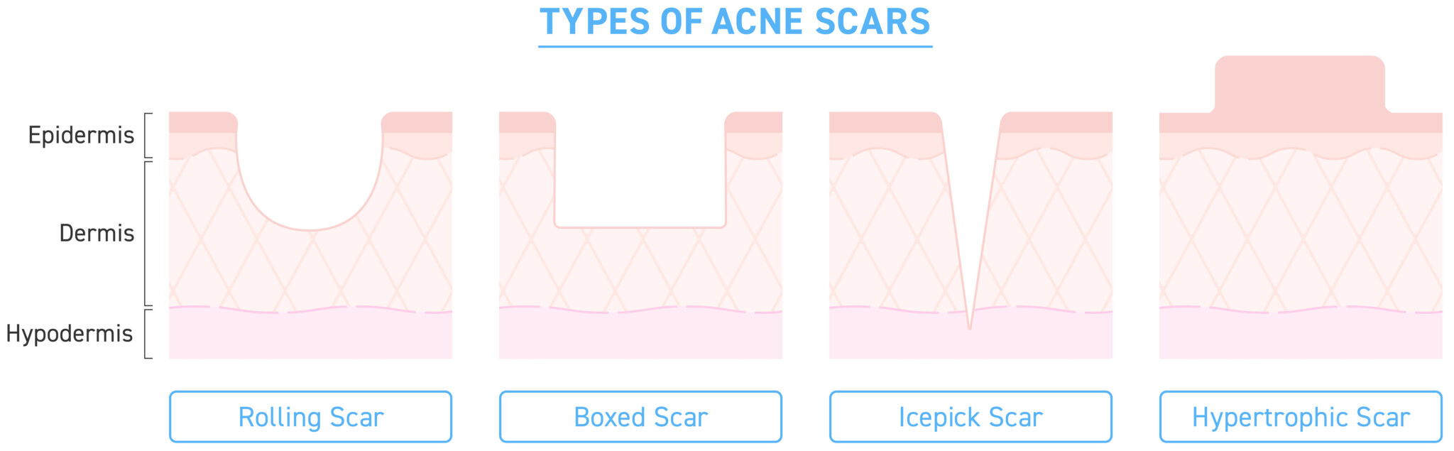 Eliminating the Appearance of Acne Scars - VINA Laser Med Spa